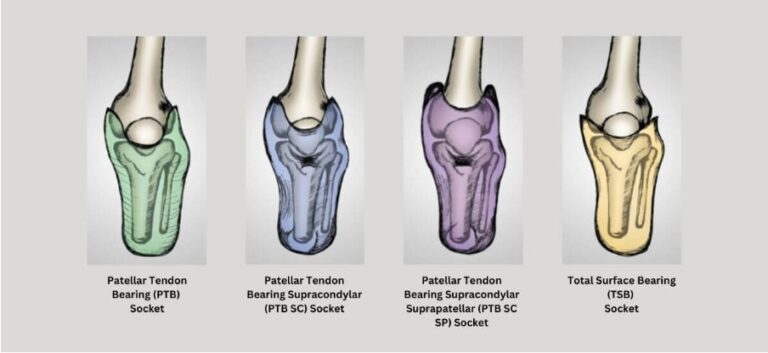 Understanding Prosthetics Socket Design: Types, Purpose & Importance