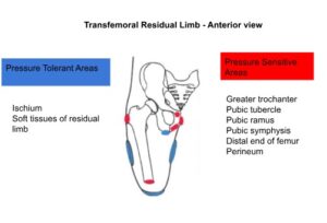 Understanding Prosthetics Socket Design: Types, Purpose & Importance