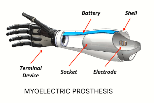 What Is a Prosthetic Limb? A Beginner's Guide to Understanding ...