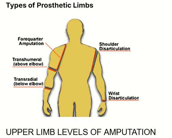 What Is a Prosthetic Limb? A Beginner's Guide to Understanding ...