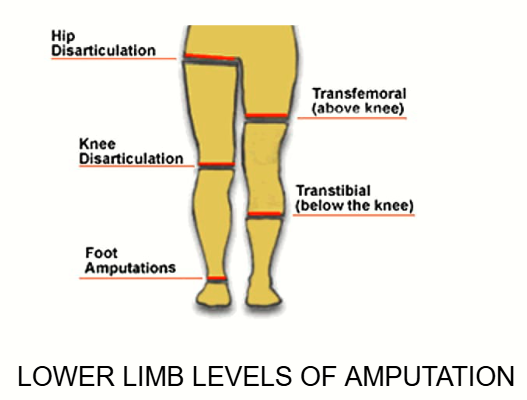 What Is a Prosthetic Limb? A Beginner's Guide to Understanding ...